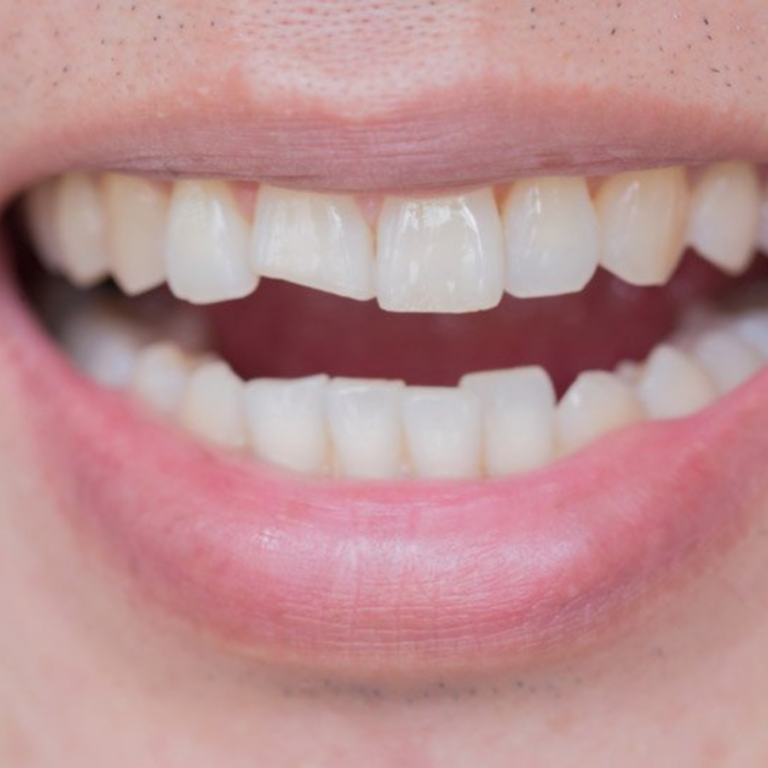 How to Repair a Chipped Front Tooth - Ellicott Mills Dental